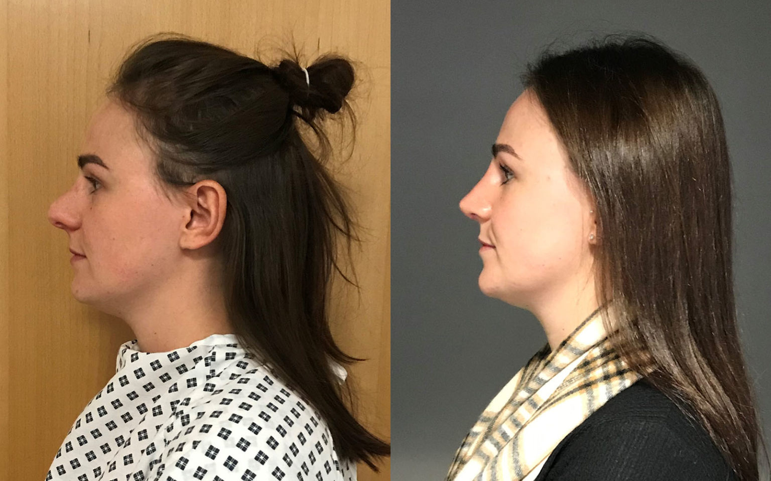 Revision Rhinoplasty - Case Study 5 - Waseem Saeed - Plastic Surgeon