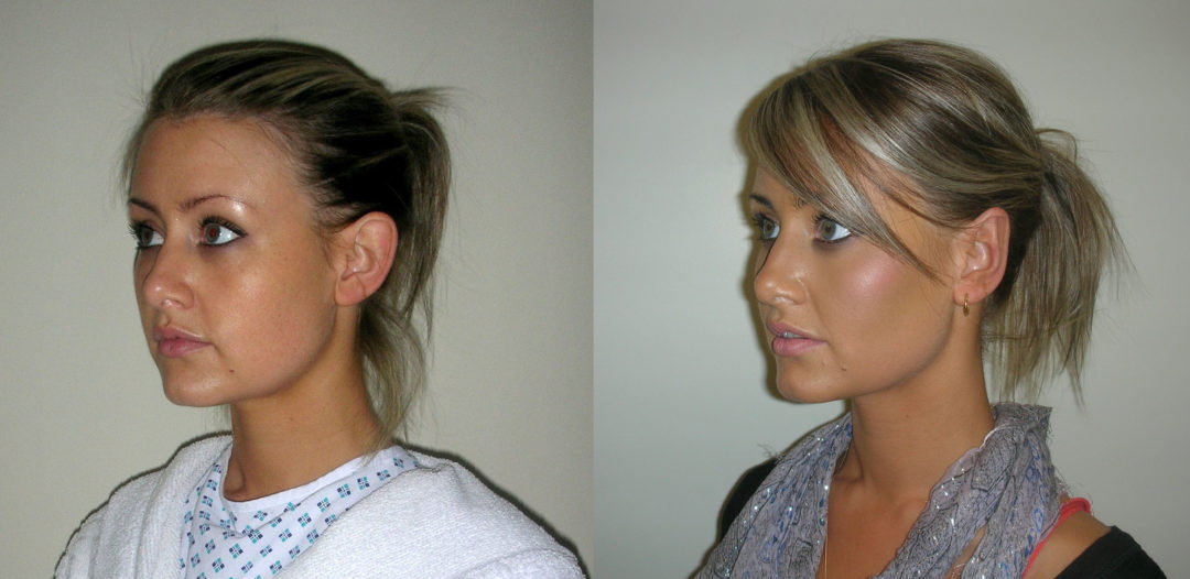 Prominent ears/pinnaplasty surgery in Manchester and London - Waseem ...