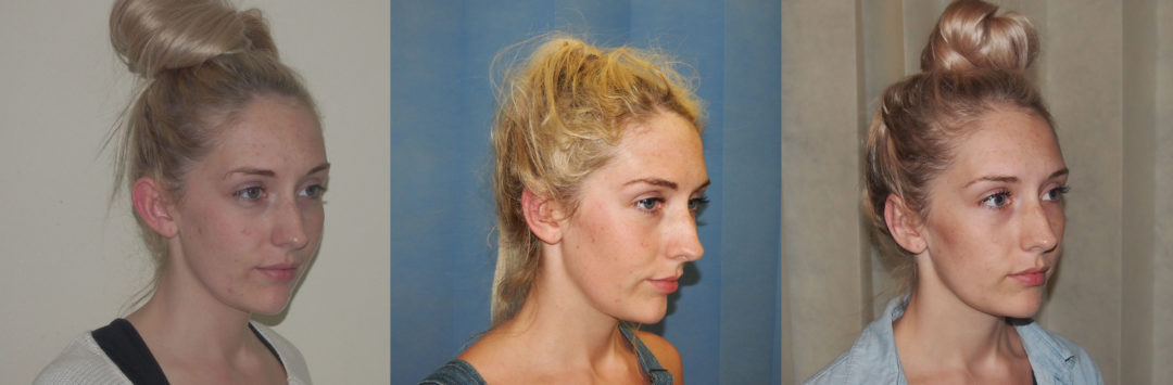 Prominent ears/pinnaplasty surgery in Manchester and London - Waseem ...