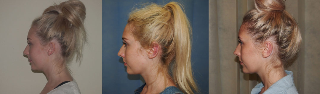 Prominent ears/pinnaplasty surgery in Manchester and London - Waseem ...