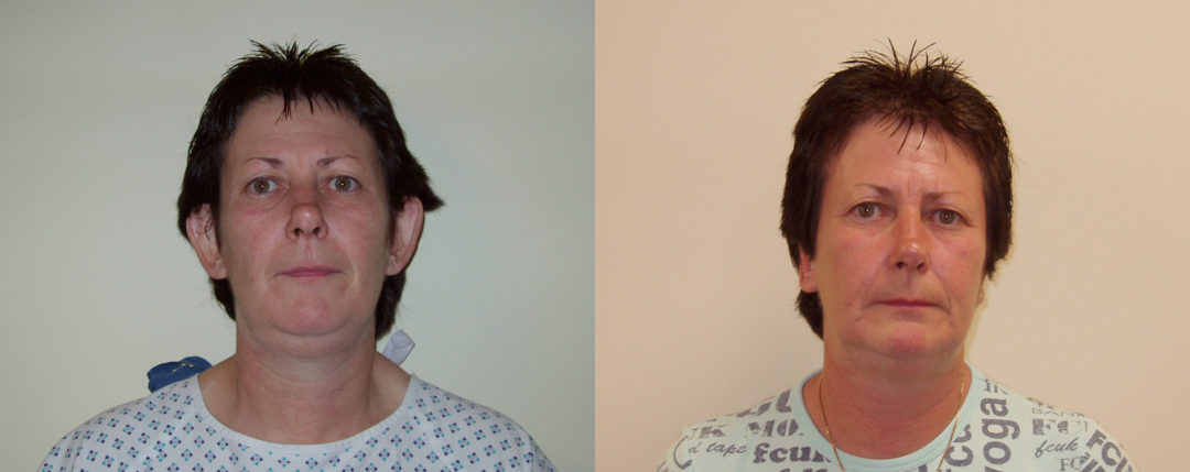 Prominent ears/pinnaplasty surgery in Manchester and London - Waseem ...