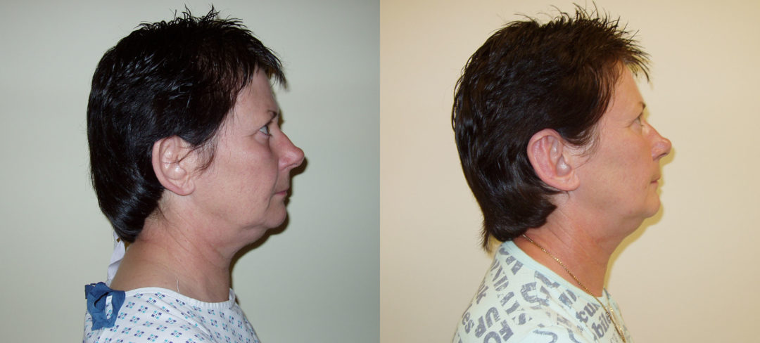 Prominent ears/pinnaplasty surgery in Manchester and London - Waseem ...