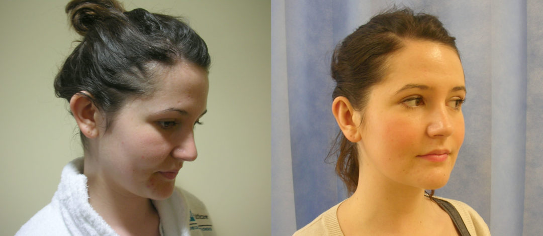 Prominent-ears-pinnaplasty-manchester5 - Waseem Saeed - Plastic Surgeon